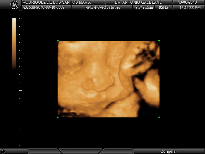 Diagnóstico prenatal: el estudio genético del feto - Bebé feliz